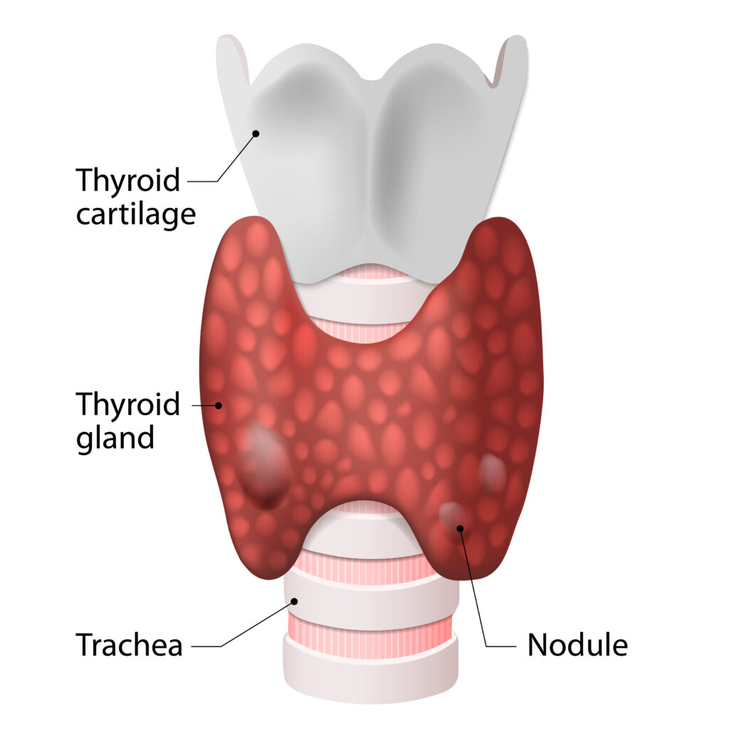 N dulo Da Tiroide ADTI N dulo Da Tiroide ADTI